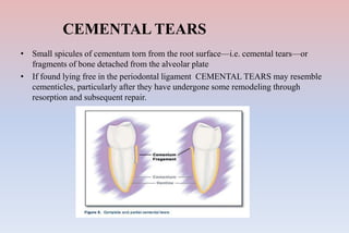 Cementum | PPTX