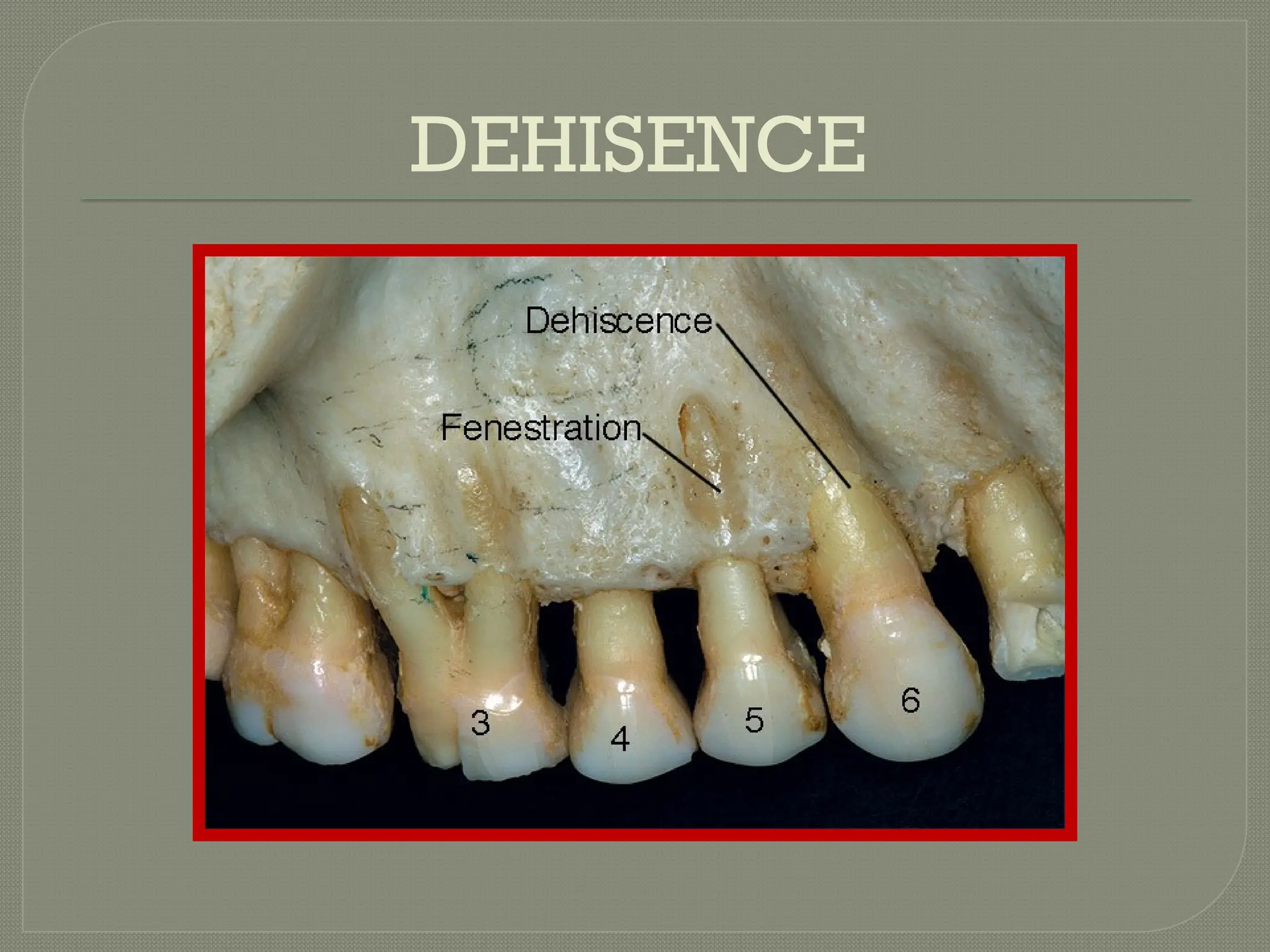 Cementum, a supporting structure of periodontium. | PPTX