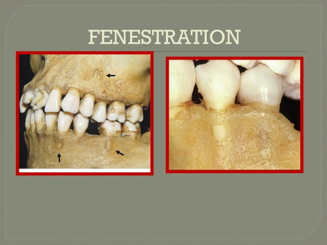 Cementum, a supporting structure of periodontium. | PPT