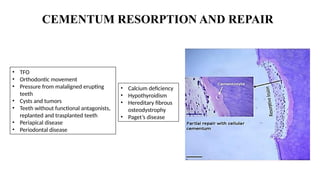 BASIC TISSUES CEMENTUM AND PERIODONTIUMM | PPTX