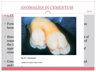 Cementum in health and disease | PPTX