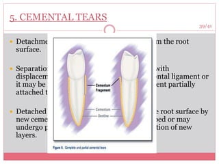 Cementum in health and disease | PPTX