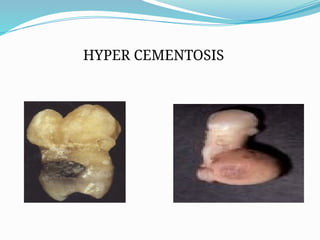 cementum in health and disease.pptx periodontology | PPTX