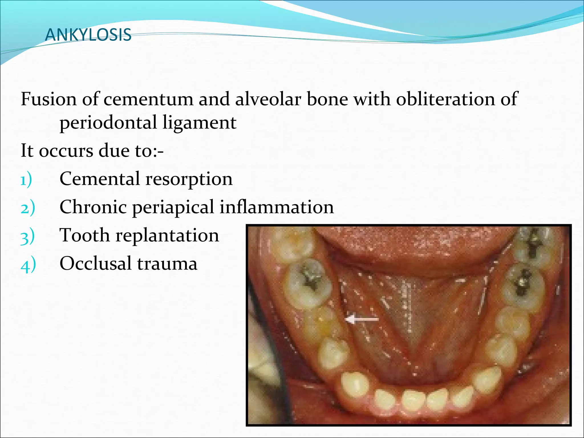 Cementum | PPT