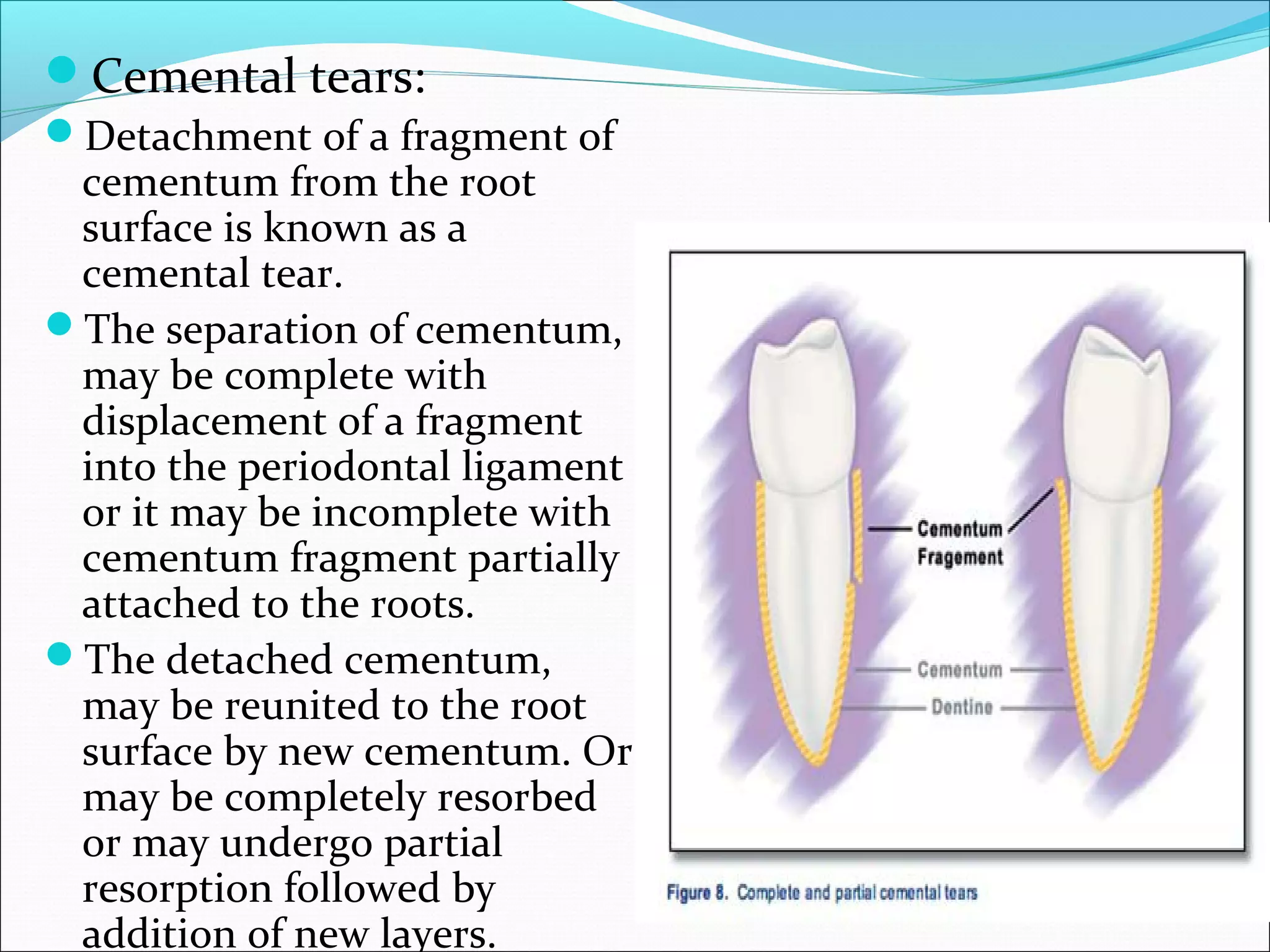 Cementum | PPT