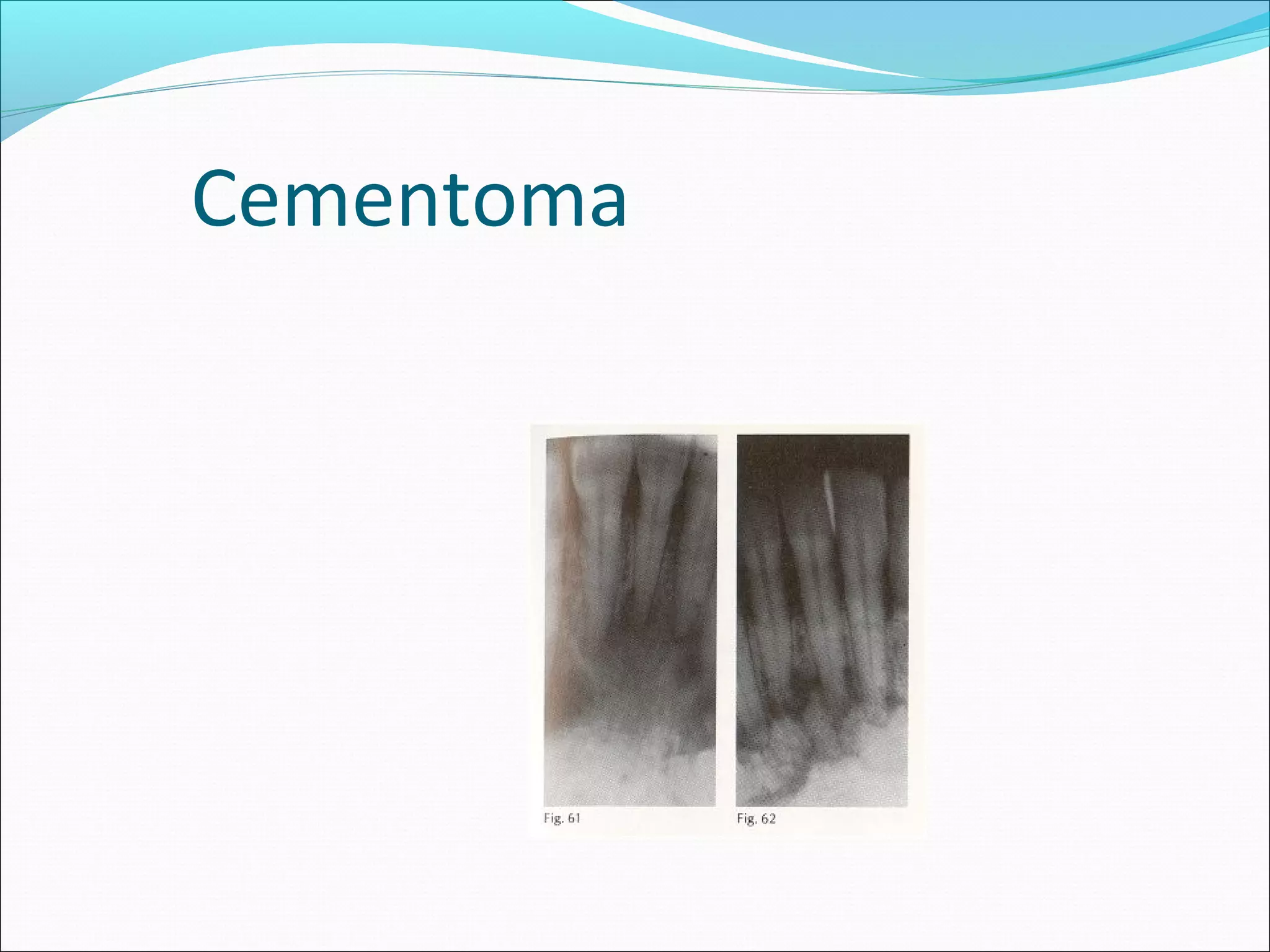 Cementum | PPT