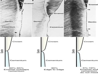 cementum in periodontics and classification of cementum, composition of ...