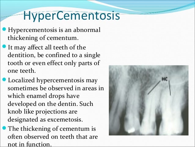 Cementoblastoma Vs Hypercementosis