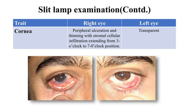 A 27-year-old male with bilateral red eyes.pptx