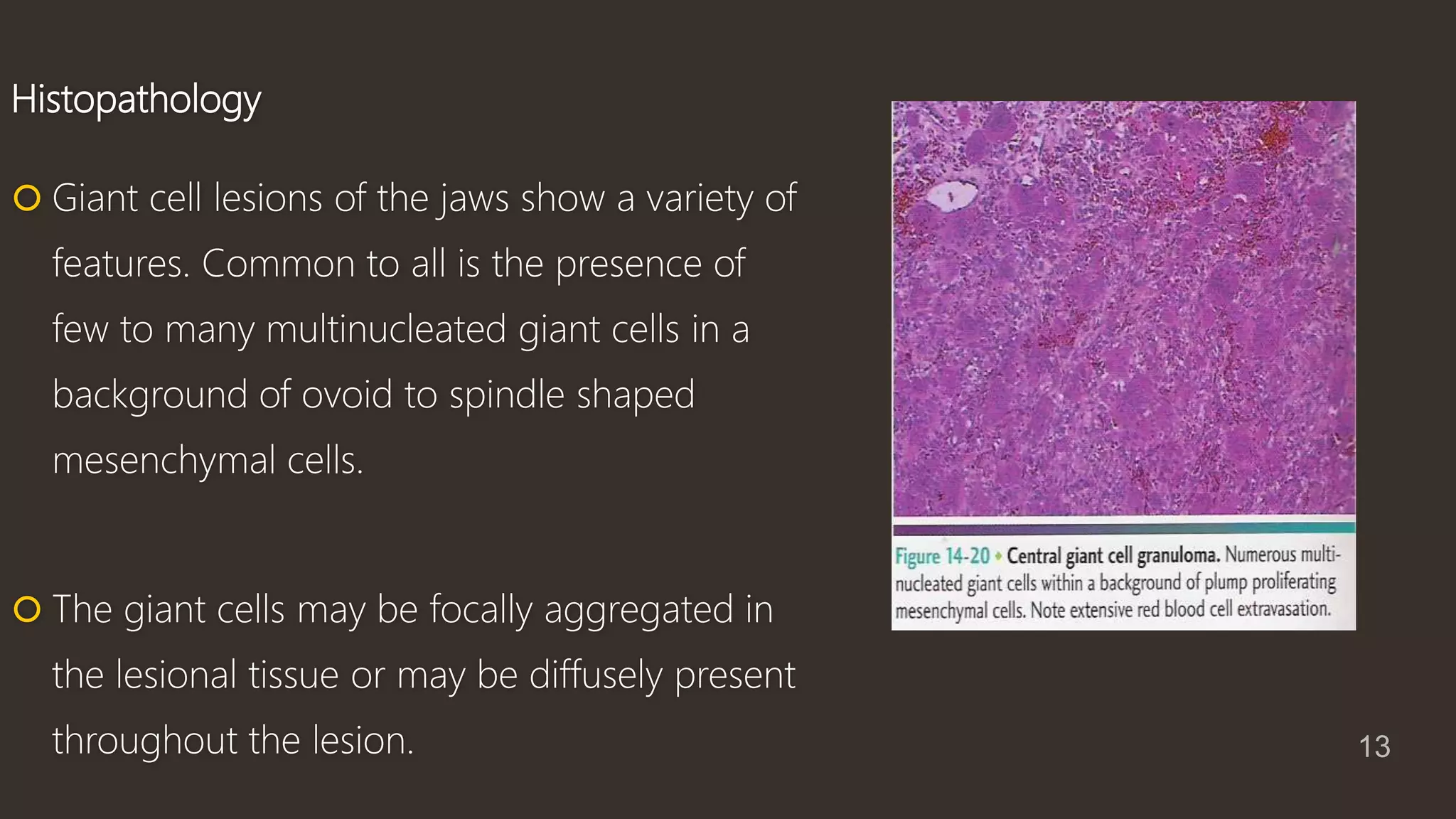 Central giant cell granuloma | PPTX