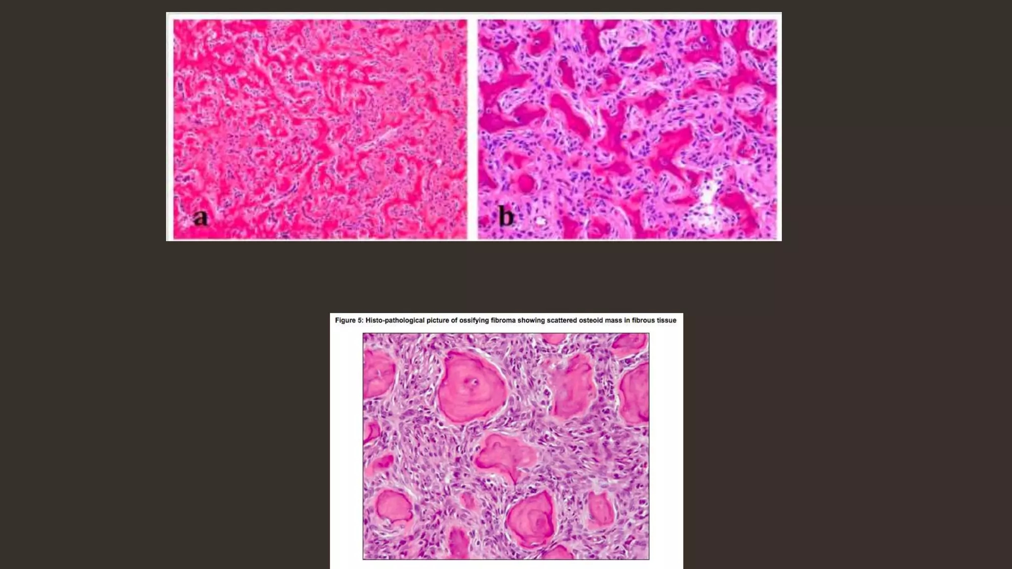Central giant cell granuloma | PPTX