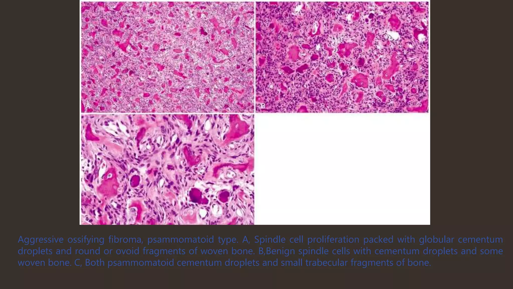 Central giant cell granuloma | PPTX