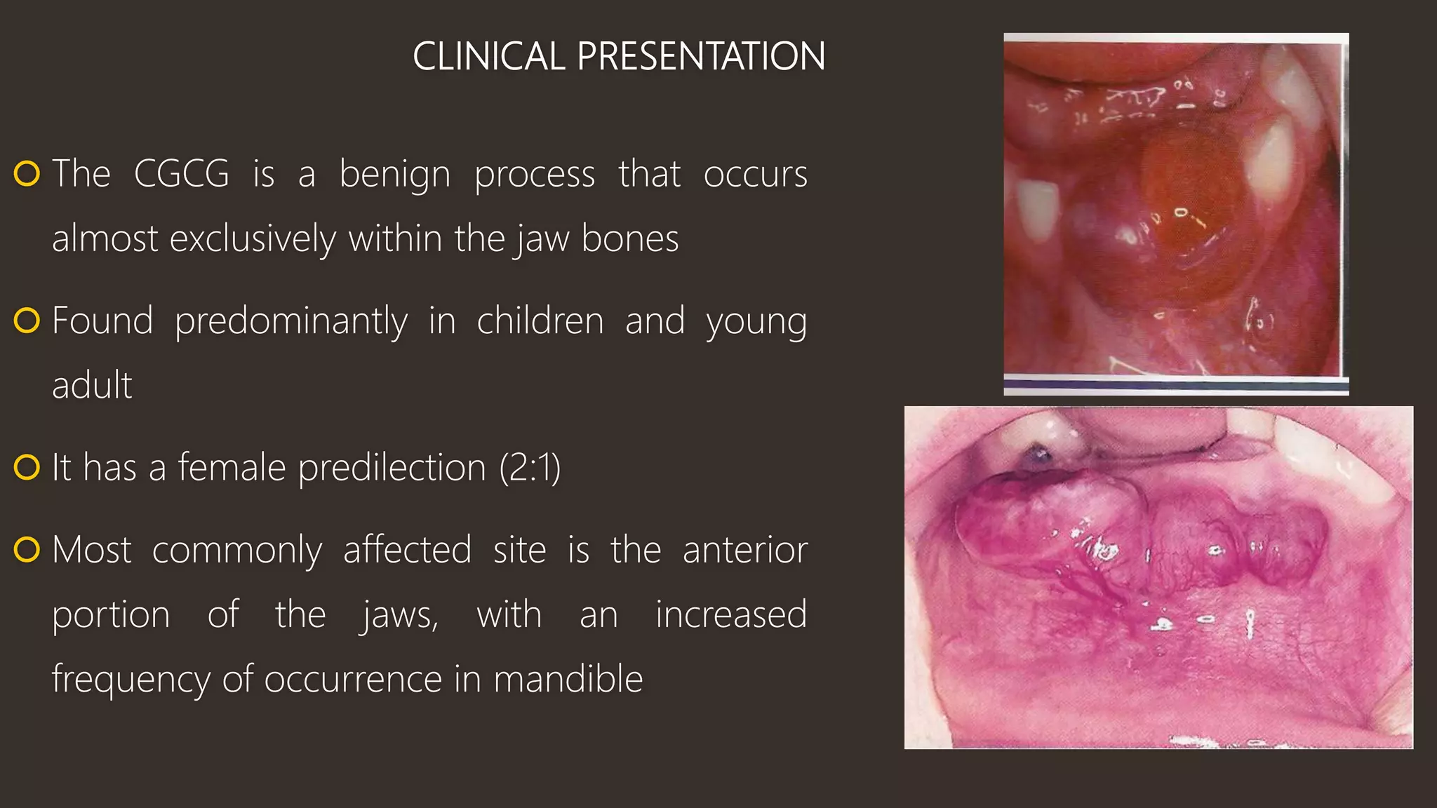 Central giant cell granuloma | PPTX
