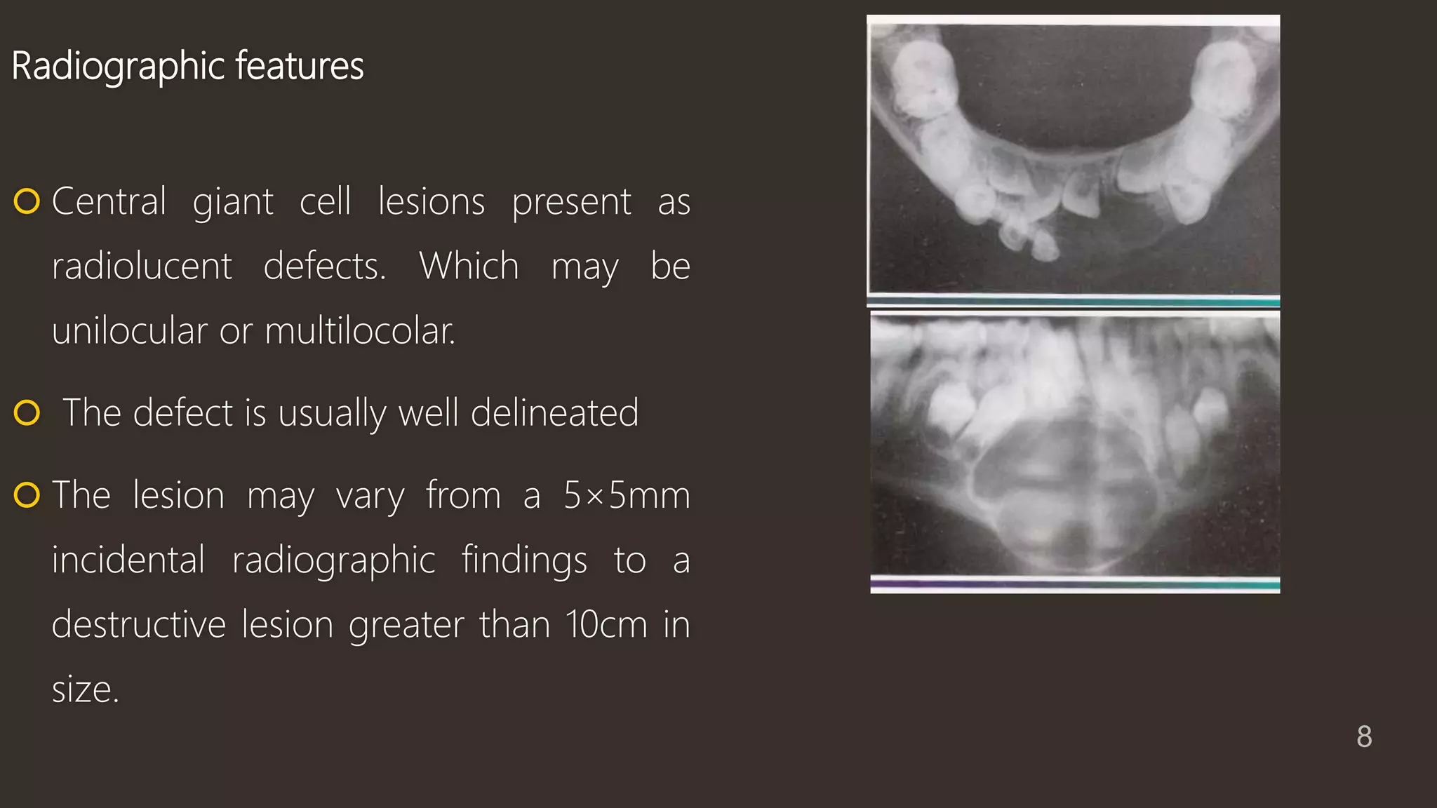 Central giant cell granuloma | PPTX
