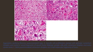 Central Giant Cell Granuloma Histology