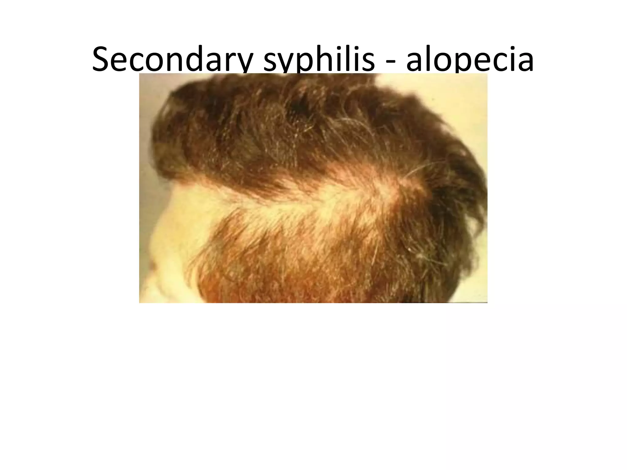 syphilis ppt | PPTX