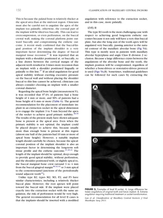 Central incisor implant | PDF