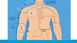 CVC Care, current CDC/NHSN CLABSI surveillance criteria are laborious ...