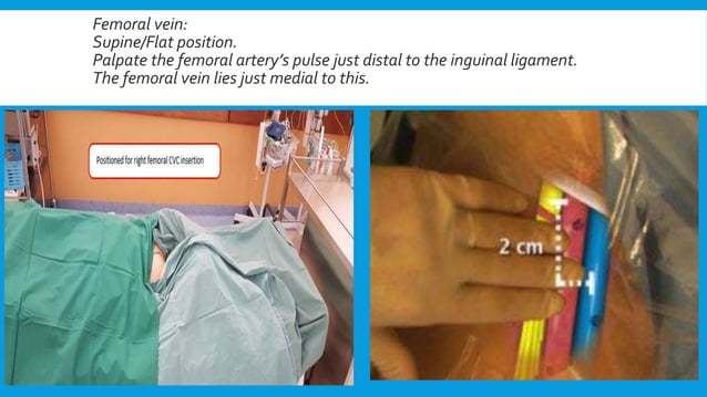 Central line placement | PPTX | First Aid | Injuries
