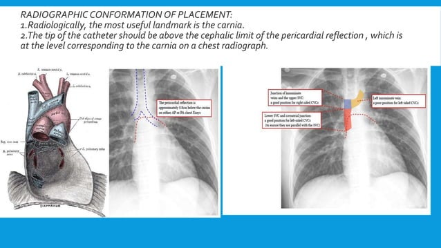 Central line placement | PPTX | First Aid | Injuries