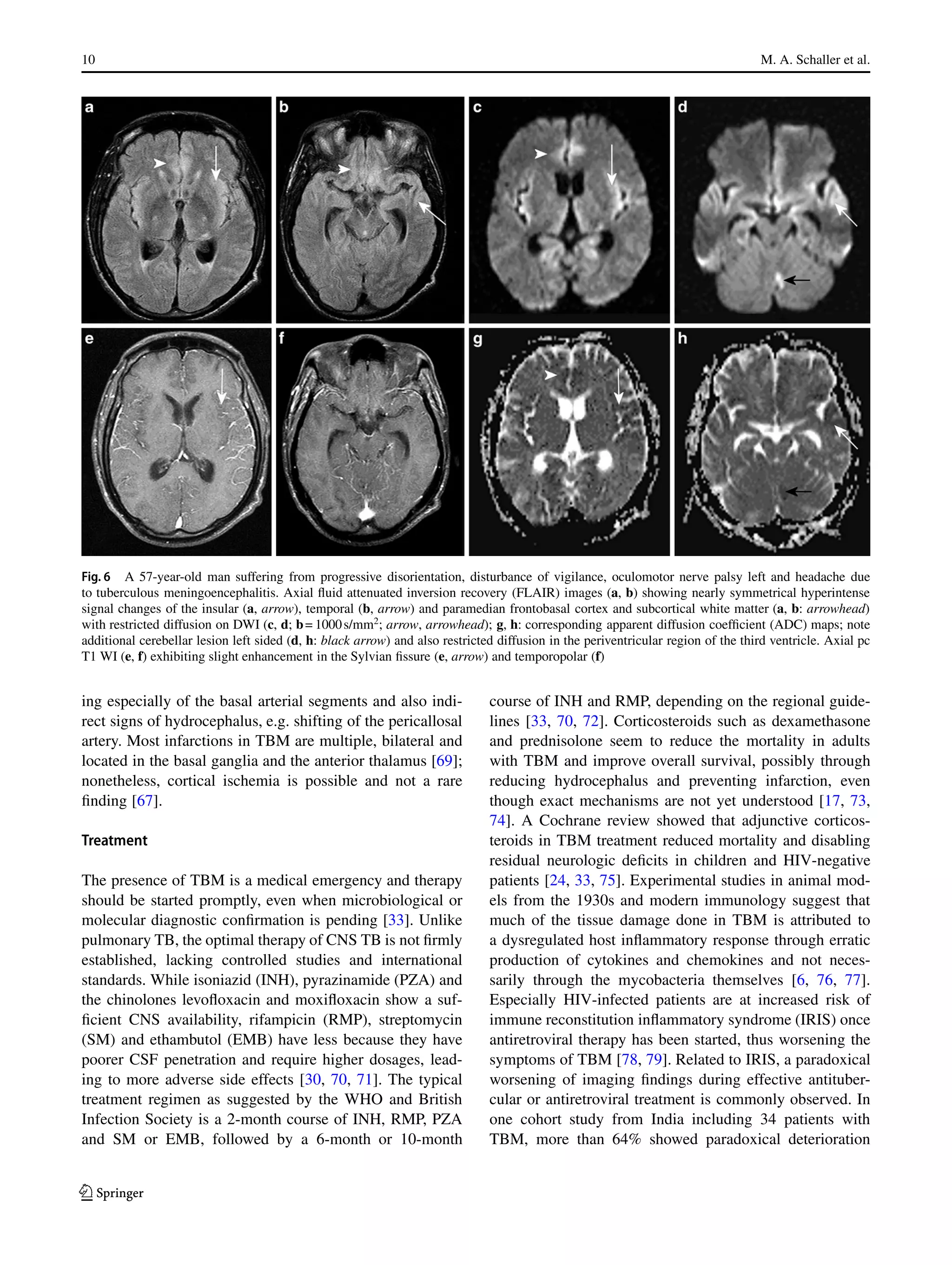 Central Nervous System Tuberculosis.pdf