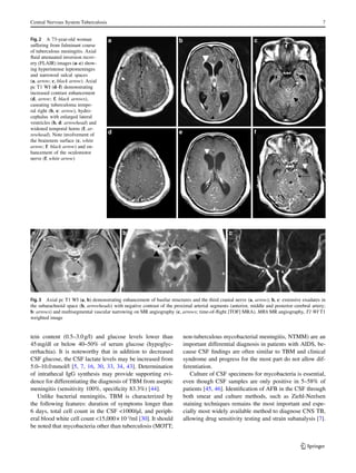 Central Nervous System Tuberculosis.pdf