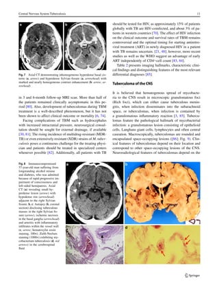 Central Nervous System Tuberculosis.pdf