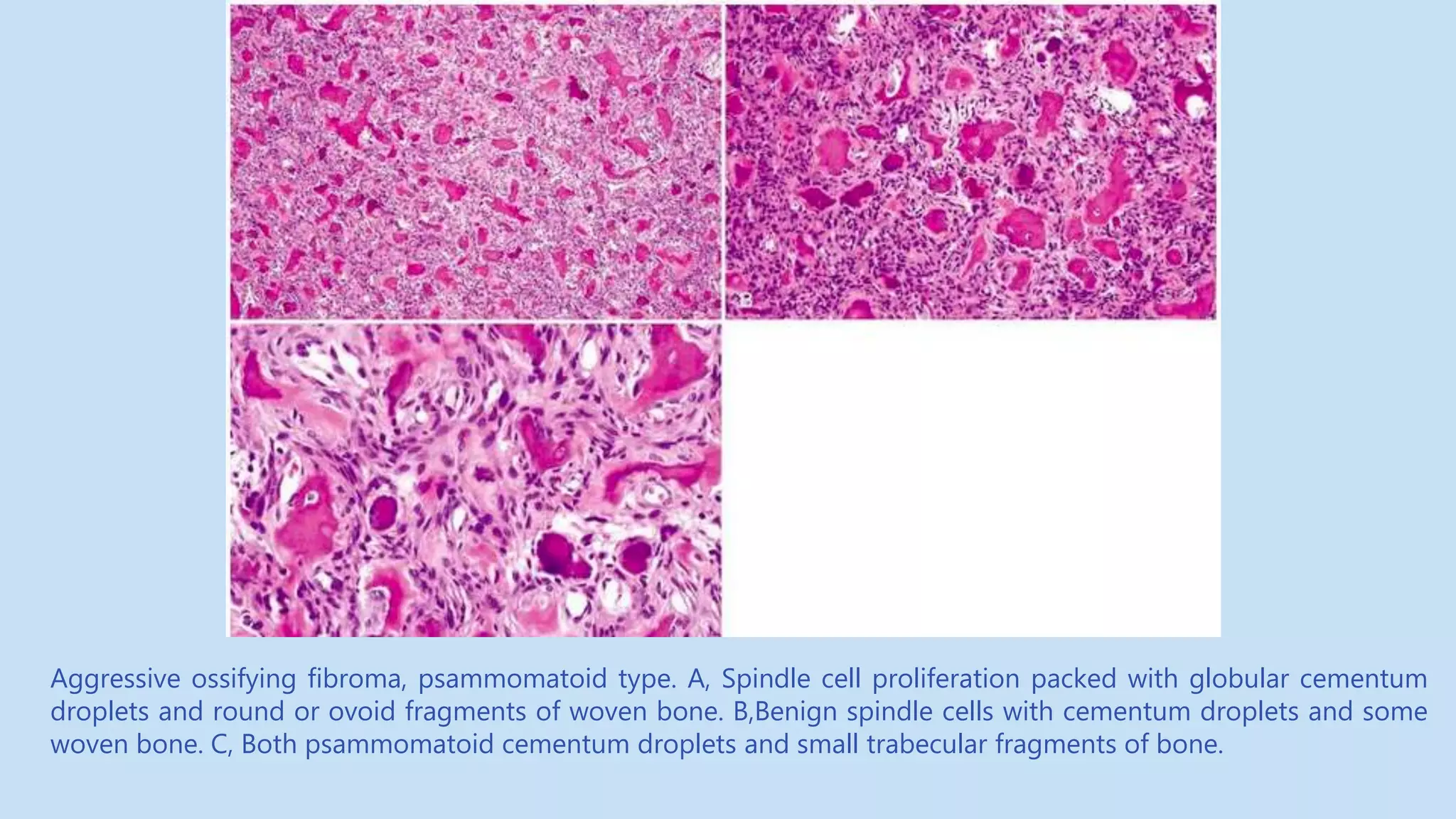 Central Ossifying Fibroma | PPTX