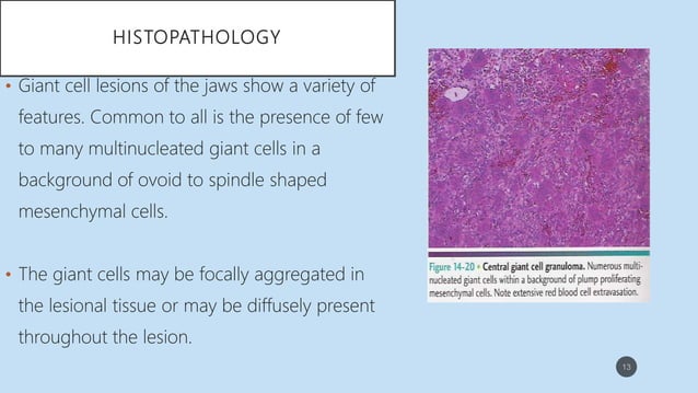Central Ossifying Fibroma | PPTX