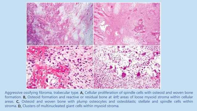 Central Ossifying Fibroma | PPTX
