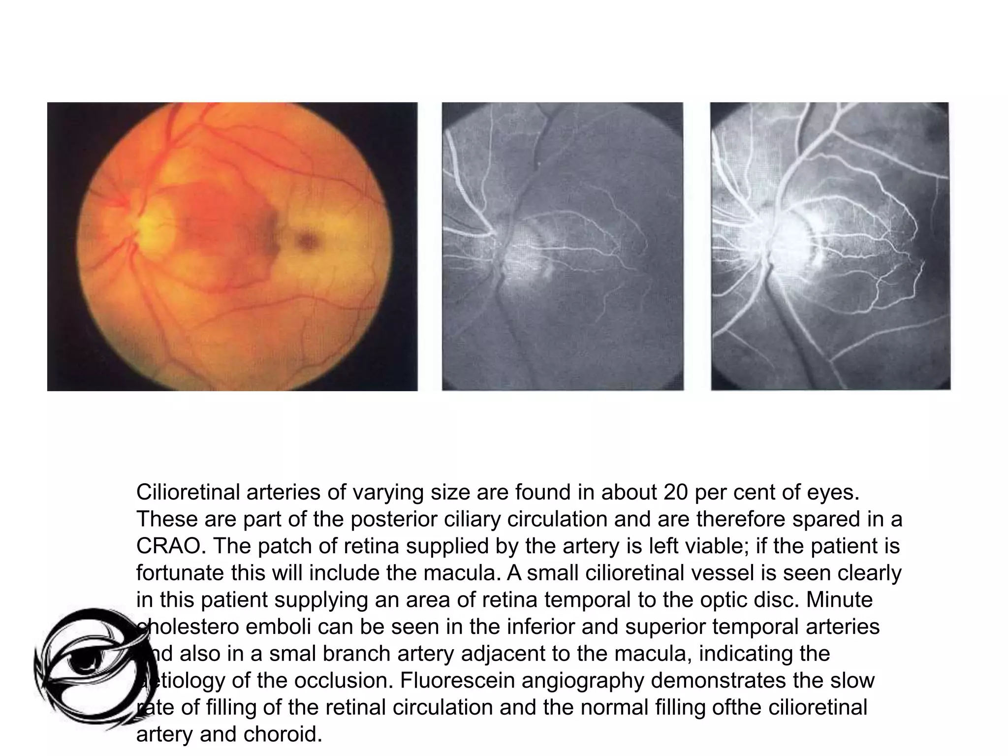 Central retinal artery occlusion | PPTX