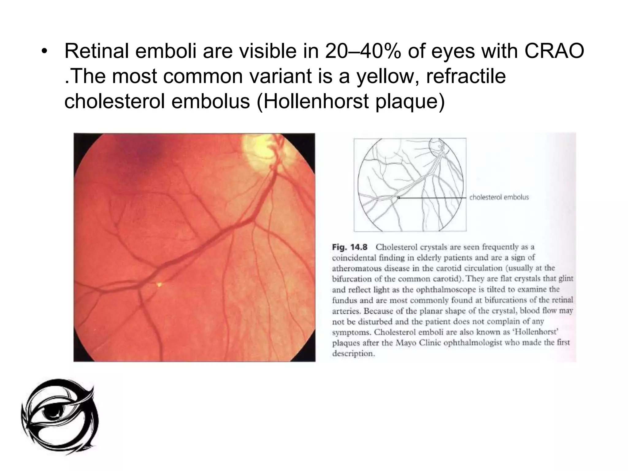Central retinal artery occlusion | PPTX