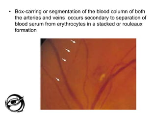 Central retinal artery occlusion | PPTX