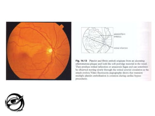 Central Retinal Artery Occlusion