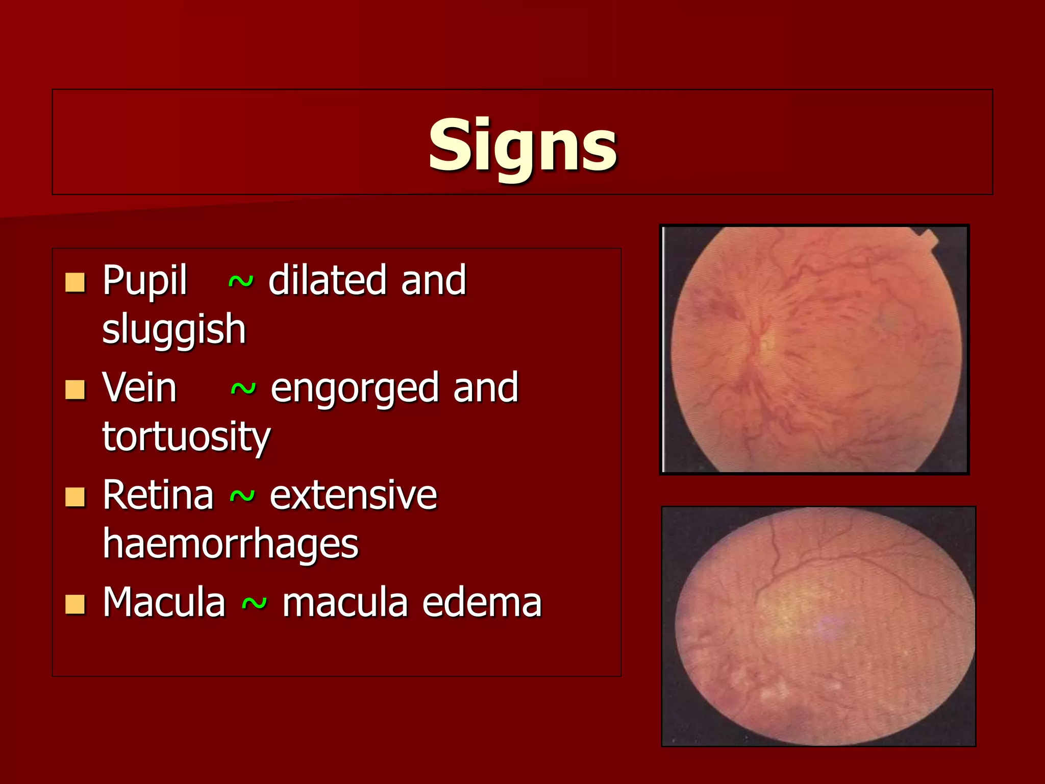 Central retinal vein occulusion | PPT