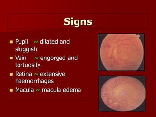 Central retinal vein occulusion | PPT