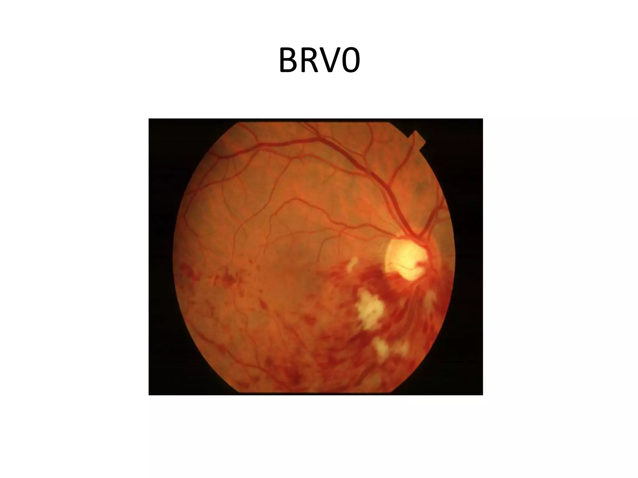 Central retinal vein thrombosis | PPT