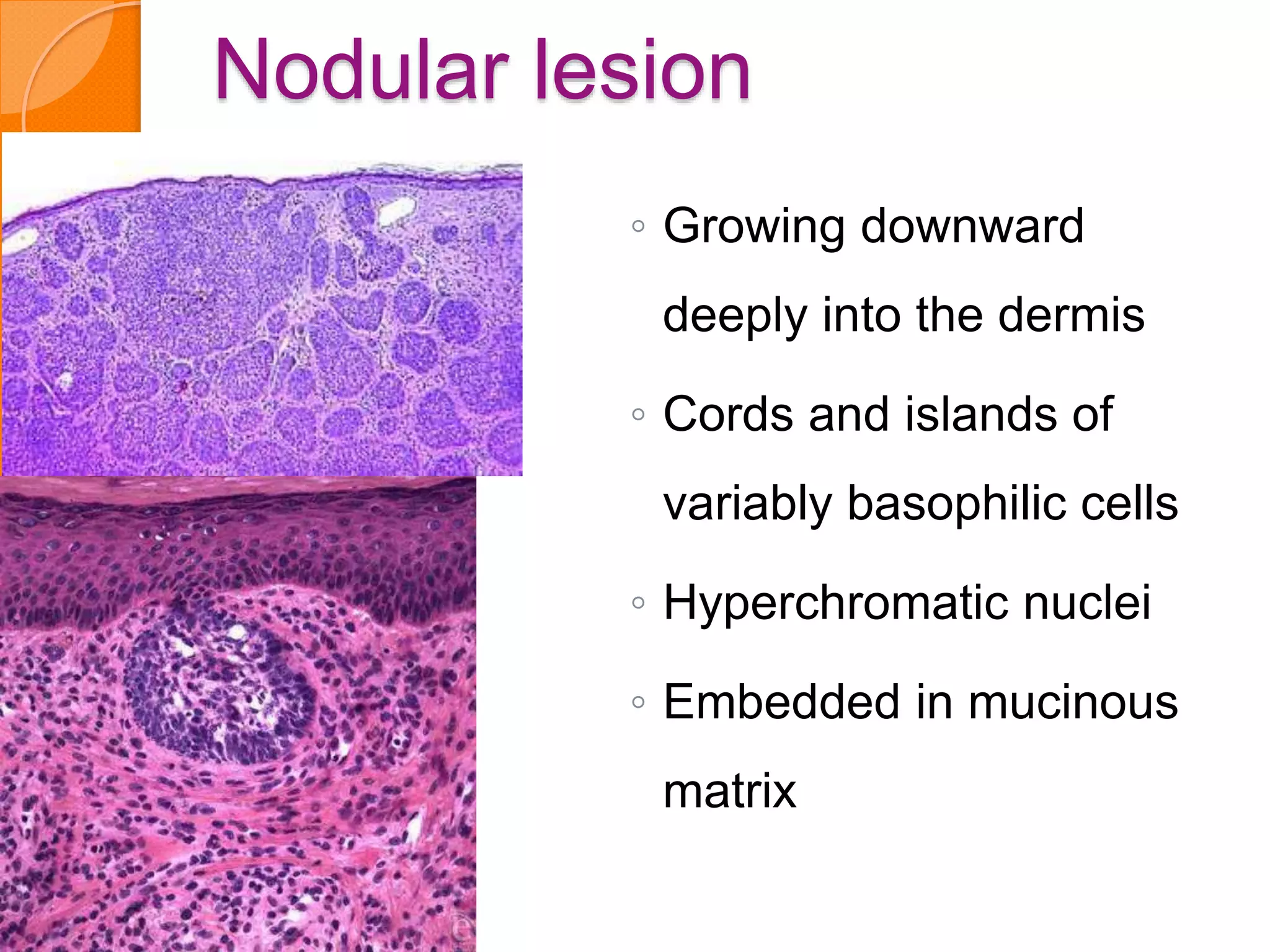 pathology of skin malignancy | PPTX