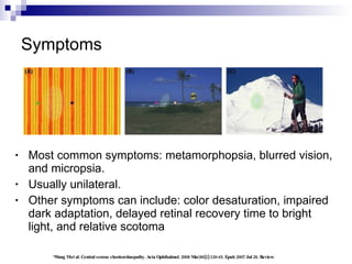 Central Serous Chorioretinopathy | PPT