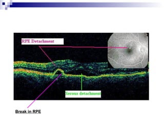 Central Serous Chorioretinopathy | PPT