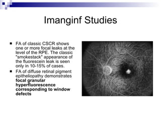 Central Serous Chorioretinopathy | PPT
