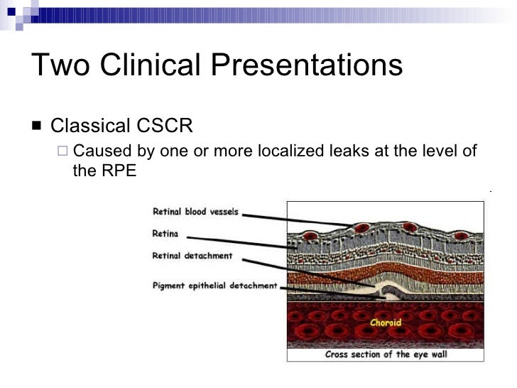 Central Serous Chorioretinopathy