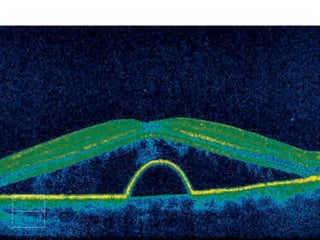 Central serous chorioretinopathy | PPT