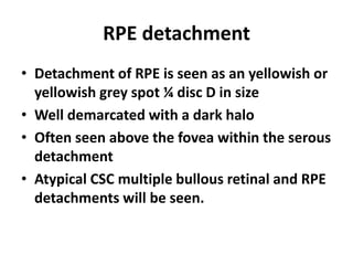 Central serous chorioretinopathy | PPTX