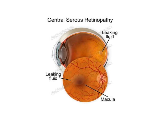 Central serous choroidopathy | PPT