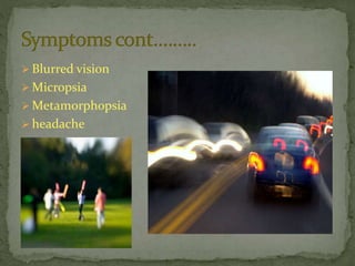 Central Serous Retinopathy Vision