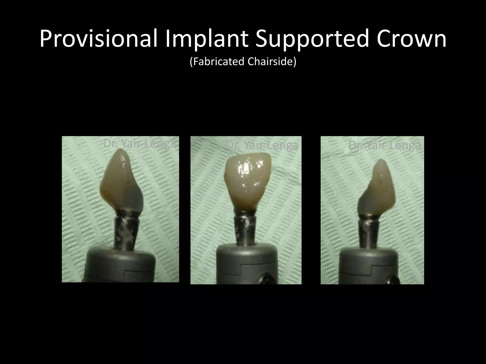 Immediate Implant Placement and Temporization | PDF