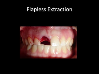 Immediate Implant Placement and Temporization | PDF