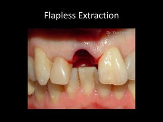 Immediate Implant Placement and Temporization | PDF