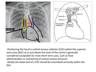Central Venous Access.pptx